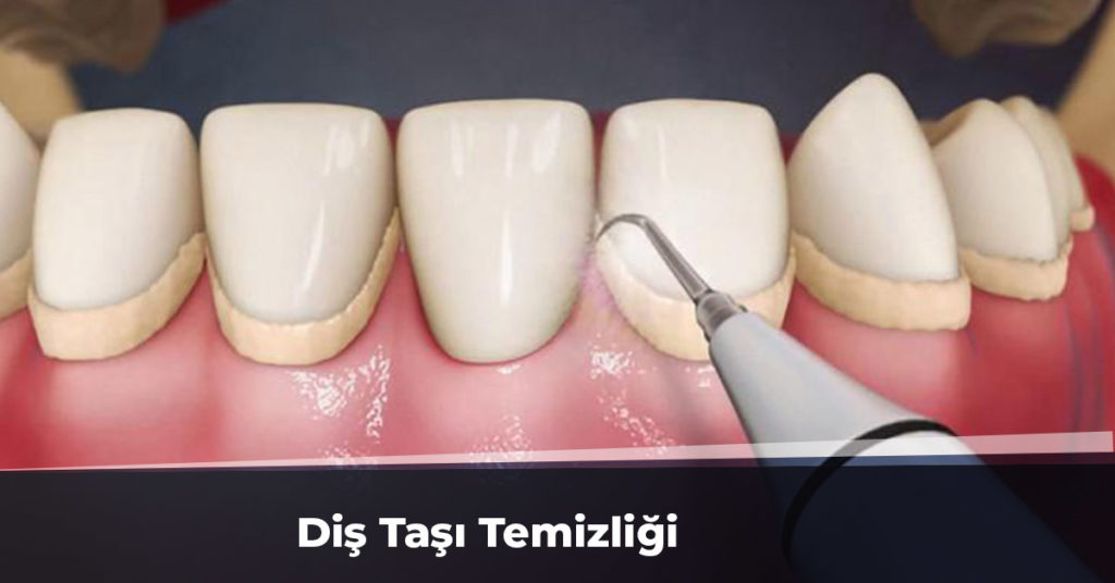 Diş Taşı Temizliği - Diş Taşı Temizliği Sonrası - Diş Taşı Temizliği Ankara
